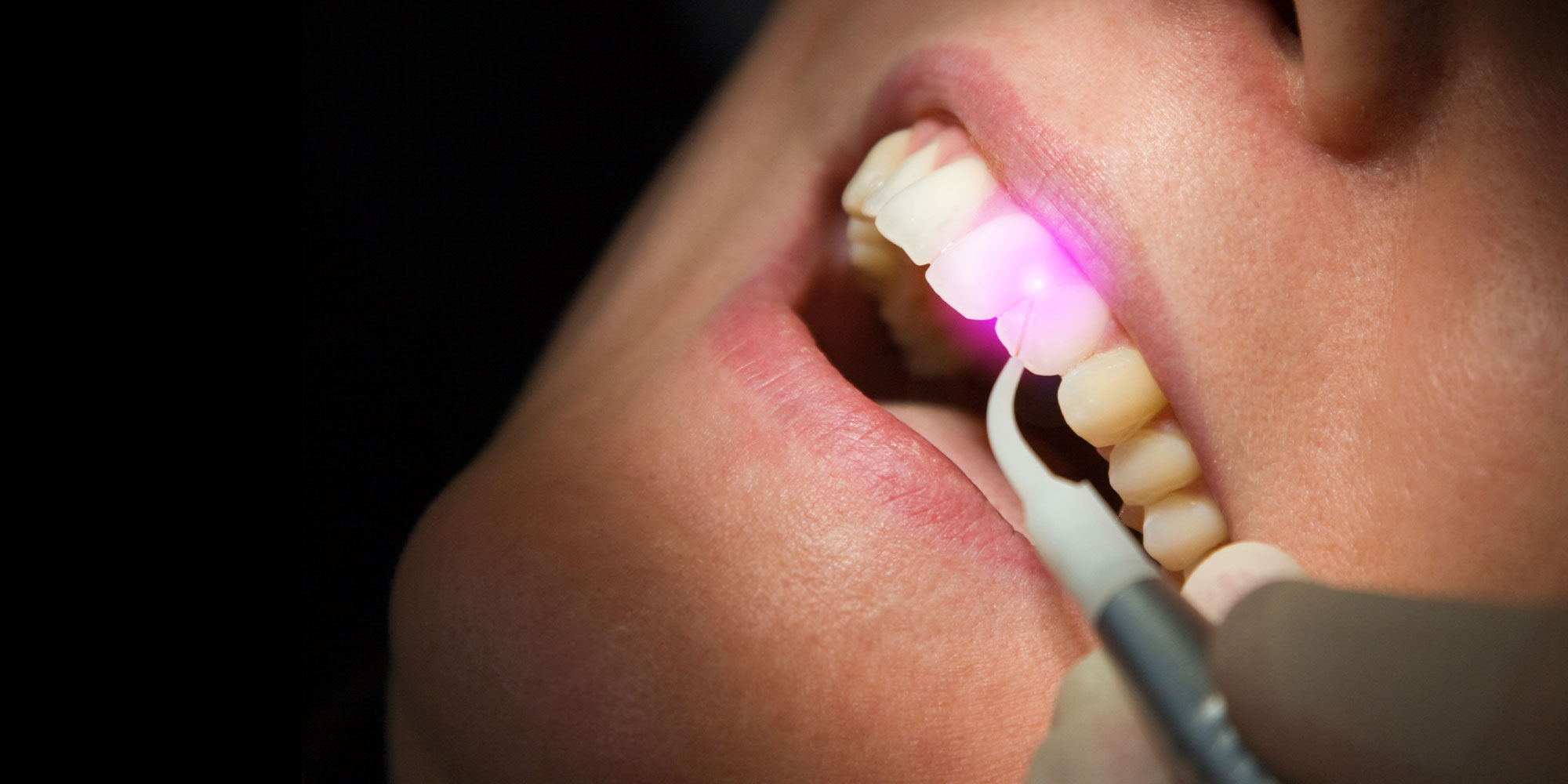 Laser Gum Depigmentation- Fort Lauderdale, FL - Dr. McCawley